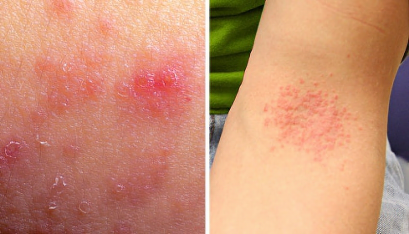 Ako vyzerá atopický ekzém u detí a ako u dospelých – príznaky a prejavy ...